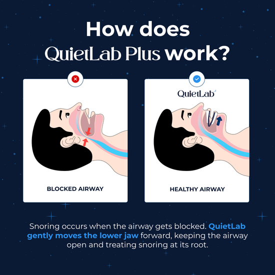 QuietLab Plus® Adjustable Anti-Snoring Mouthpiece